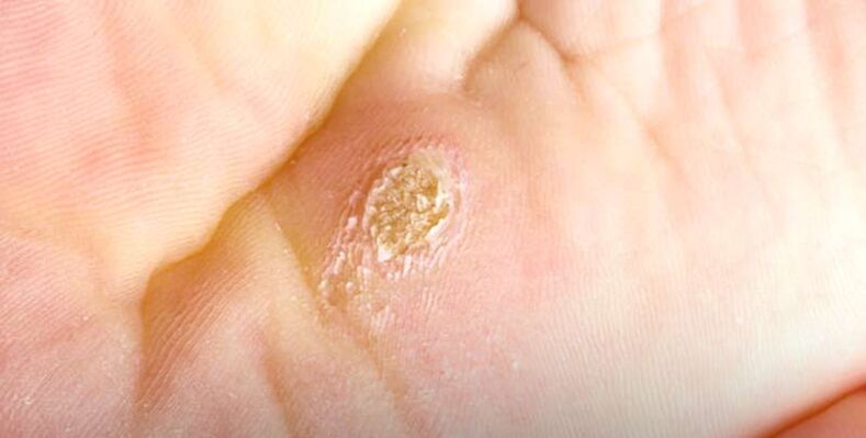 Warzen, Arten von Warzen, Symptome, Fotos und Behandlung